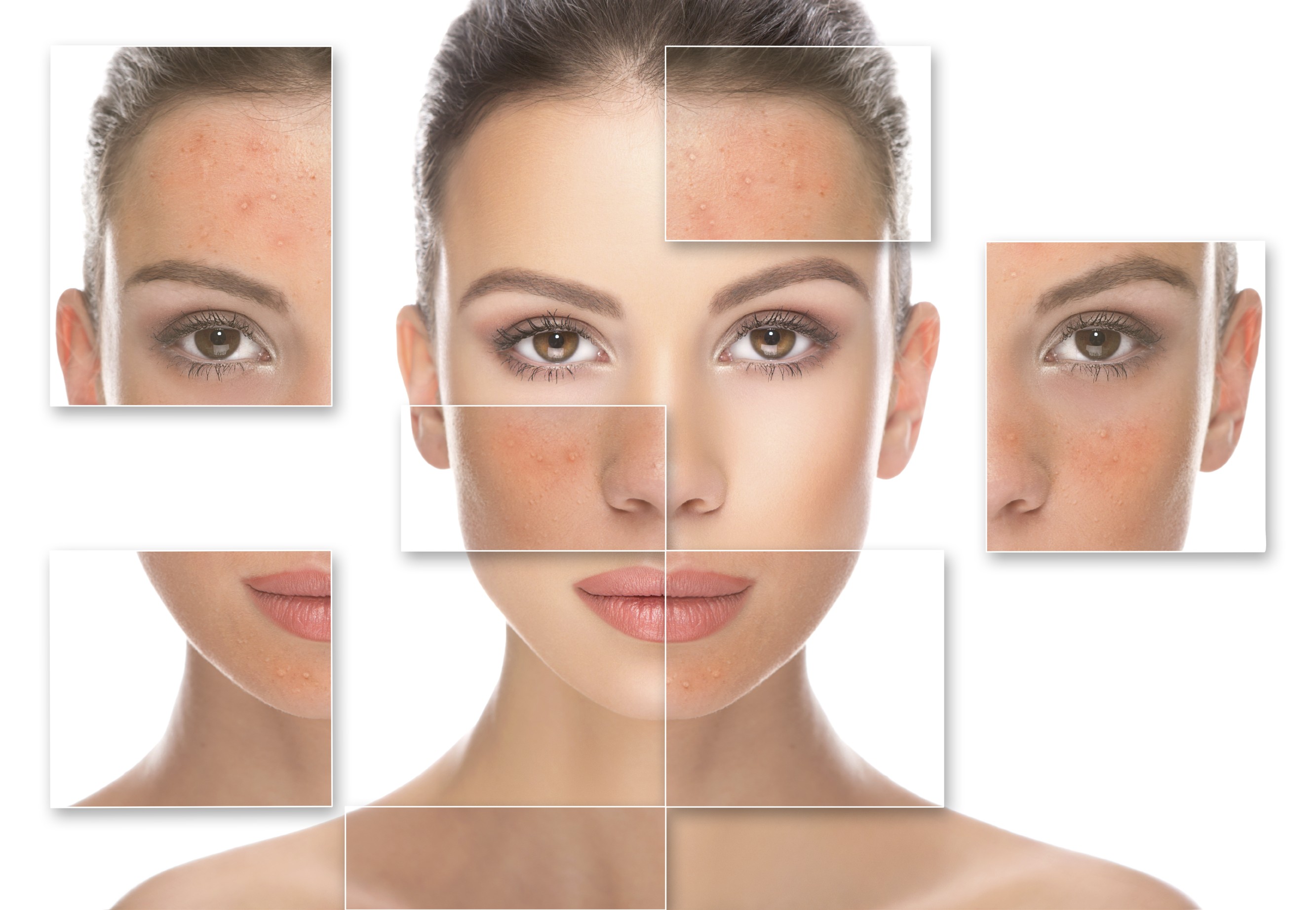 What Exactly Is Rosacea And How Can You Treat It? - NURISS Skincare and ...
